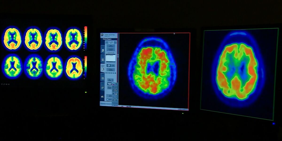Study: Experimental Alzheimer’s drug slows decline Study: Experimental Alzheimer’s drug slows decline
